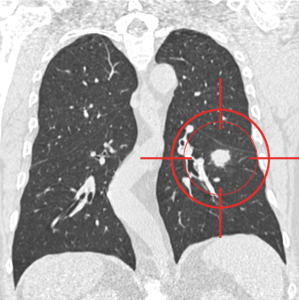 Lung Cancer Prediction | Shreshth Saxena